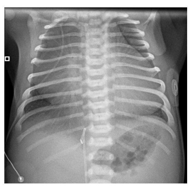 Modified Starnes procedure as a bridge to 2-ventricle repair in ...