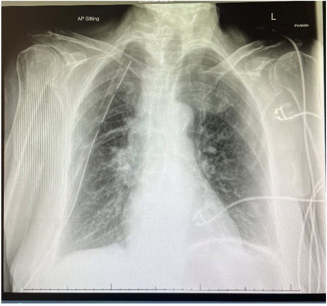 Video Atlas Of Pulmonary Segmentectomy Robotic Assisted Right S3