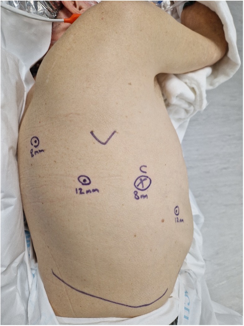 Video atlas of pulmonary segmentectomy: robotic-assisted right S3 ...