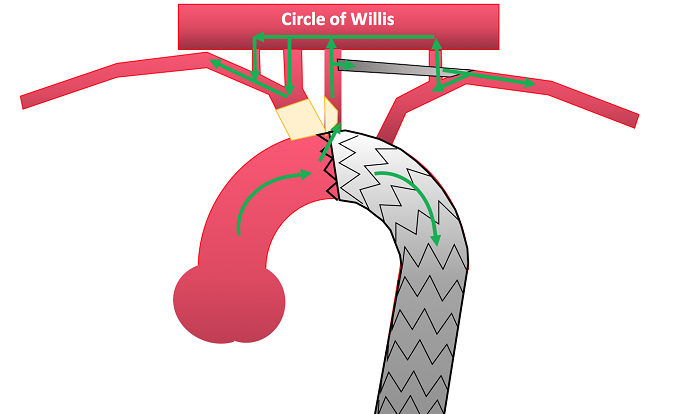 Open supra-aortic revascularization and arch reconstruction after ...
