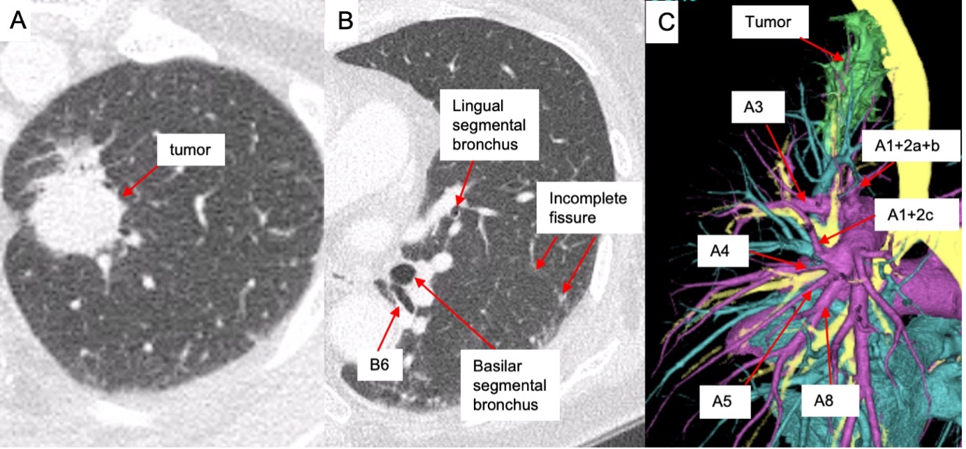 A robotic fissureless left upper lobectomy for a dense fissure | MMCTS