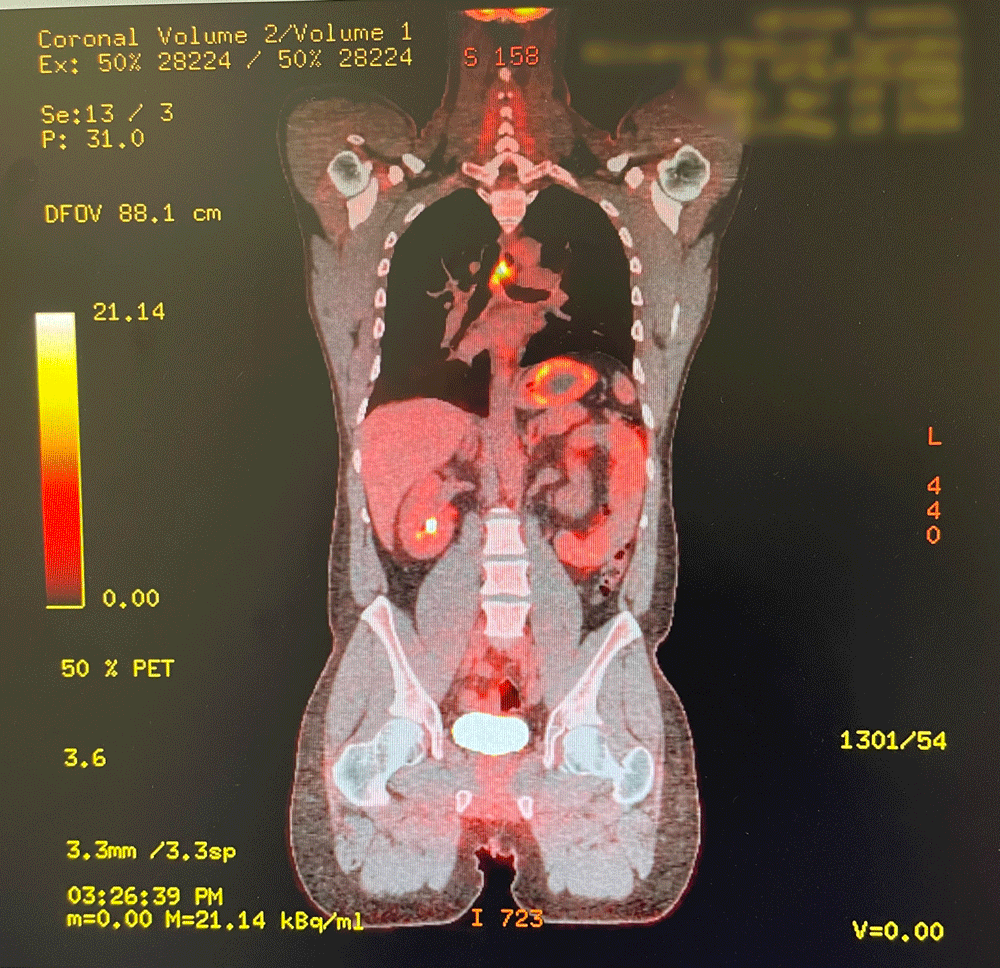Robotic-assisted carinal reconstruction using cross-table ventilation ...