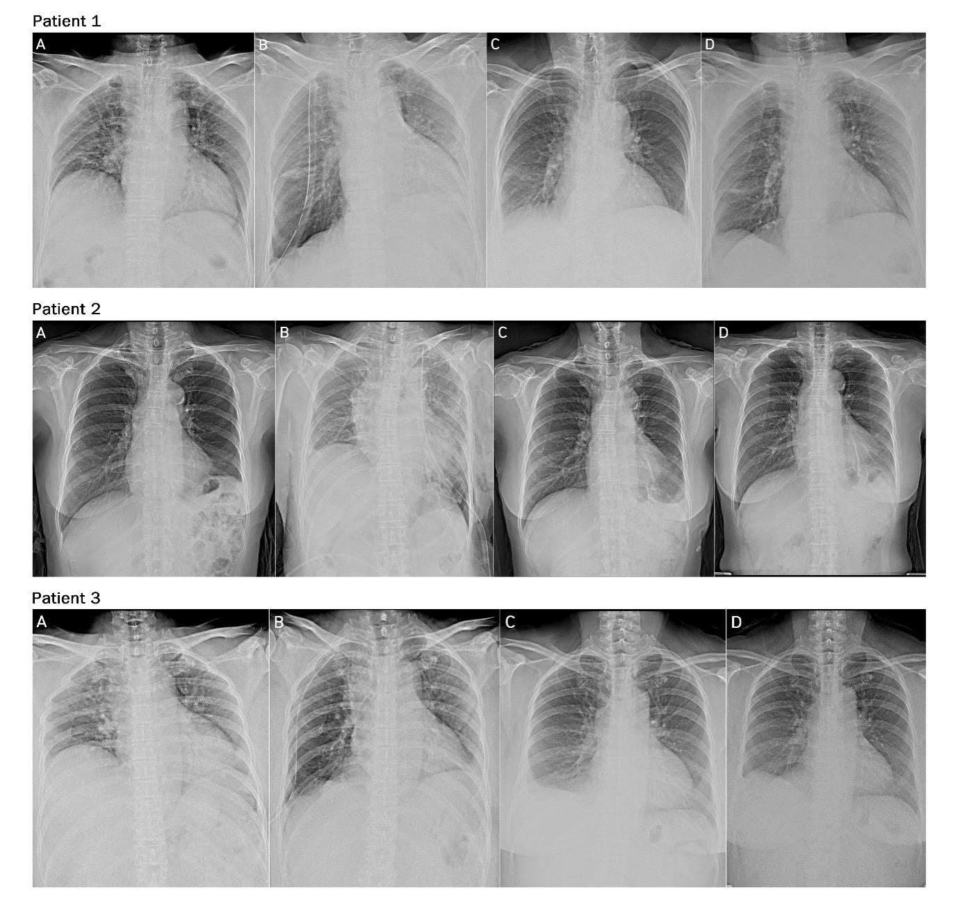 Video-assisted thoracoscopic diaphragm oblique resection simplified ...
