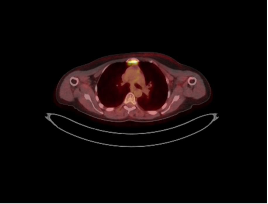 Manubriectomy made easy | MMCTS