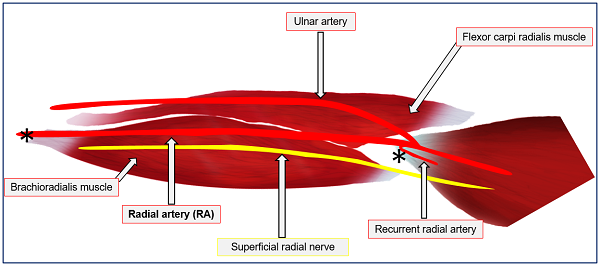 Conventional open harvesting of the radial artery as a conduit for ...