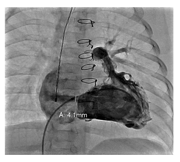 Modified Starnes procedure as a bridge to 2-ventricle repair in ...