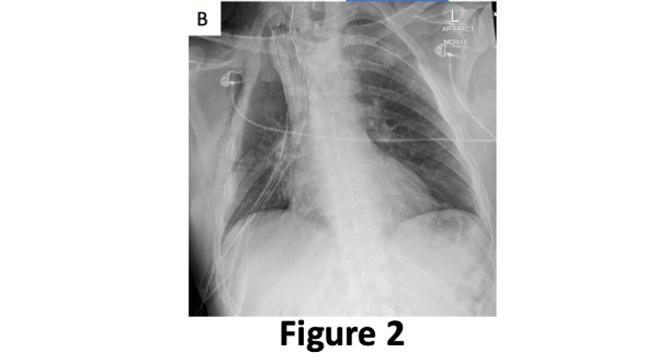 Chest Wall Resection With Robotic Assisted Thoracoscopic Surgery For A Pancoast Tumour A Case