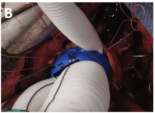 Bio-Bentall and hybrid arch frozen elephant trunk repair for acute type ...