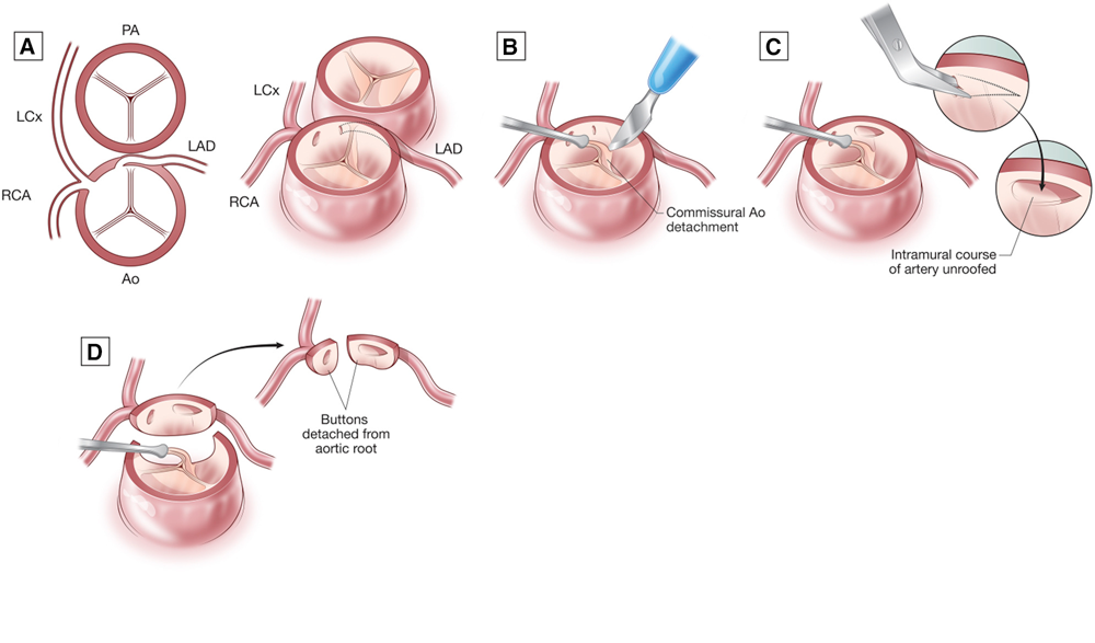 Coronary transfer for complex looping and intramural variants in the ...