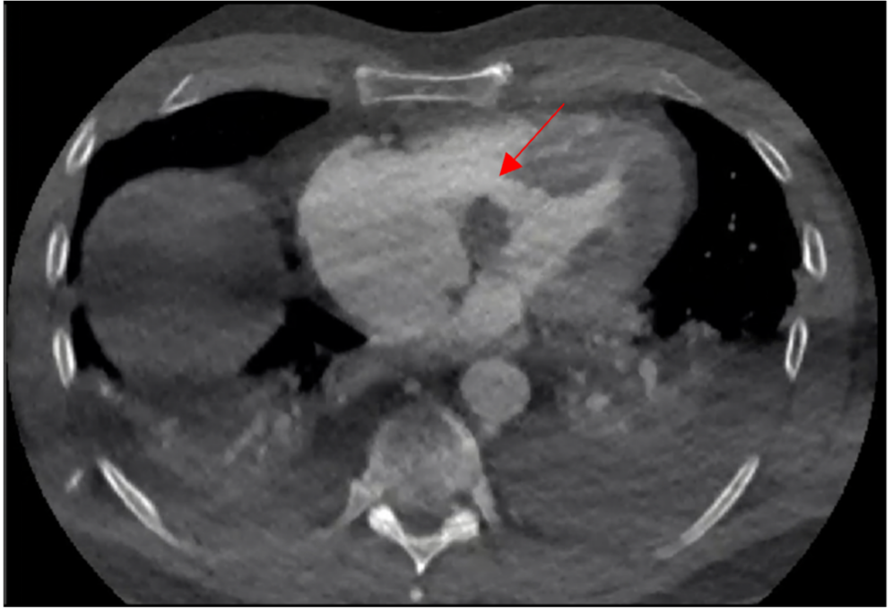 Transatrial repair of a ventricular septal defect and tricuspid valve ...