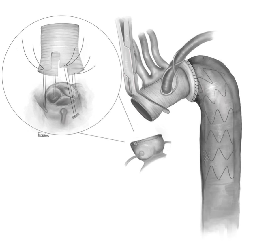 Aortic valve resuspension using the Florida sleeve technique with ...