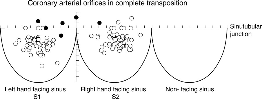 Coronary transfer for complex looping and intramural variants in the ...
