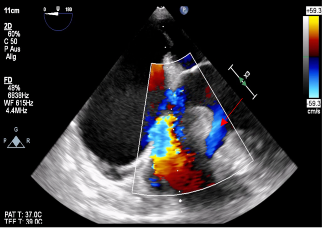 Transatrial repair of a ventricular septal defect and tricuspid valve replacement after a blunt ...