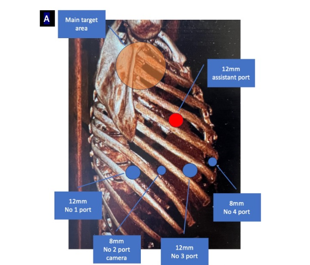 Chest Wall Resection With Robotic Assisted Thoracoscopic Surgery For A Pancoast Tumour A Case
