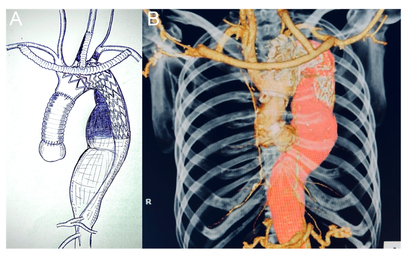 Open surgical conversion after debranching thoracic endovascular aortic ...