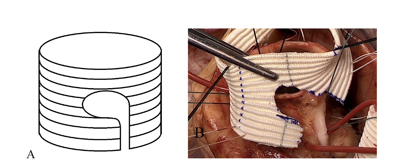 The combination of Florida sleeve and Ozaki procedures for aortic root ...