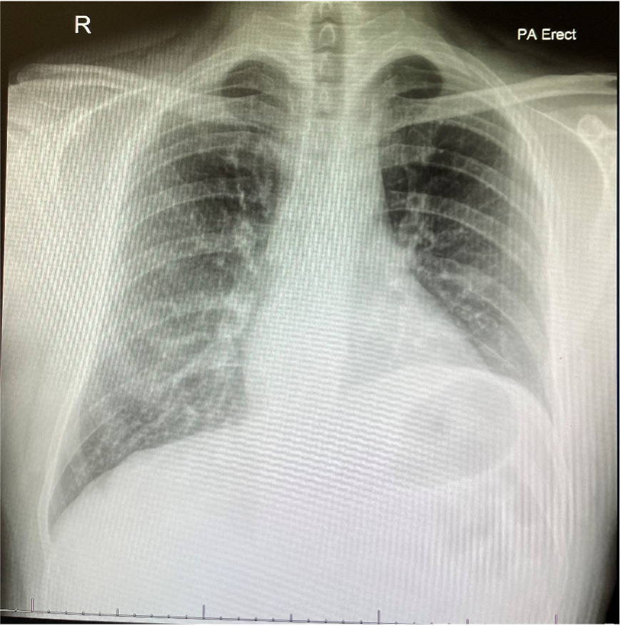 Robotic-assisted carinal reconstruction using cross-table ventilation ...