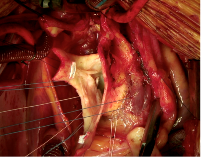 Valve-sparing root reimplantation with a Valsalva graft for a ...