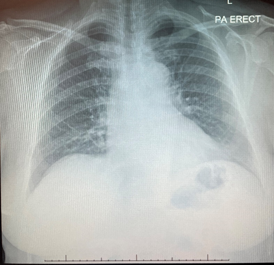 Video atlas of pulmonary segmentectomy: robotic-assisted right S1 ...