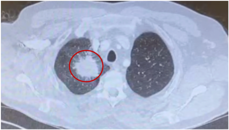 A robotic-assisted Pancoast tumour resection | MMCTS