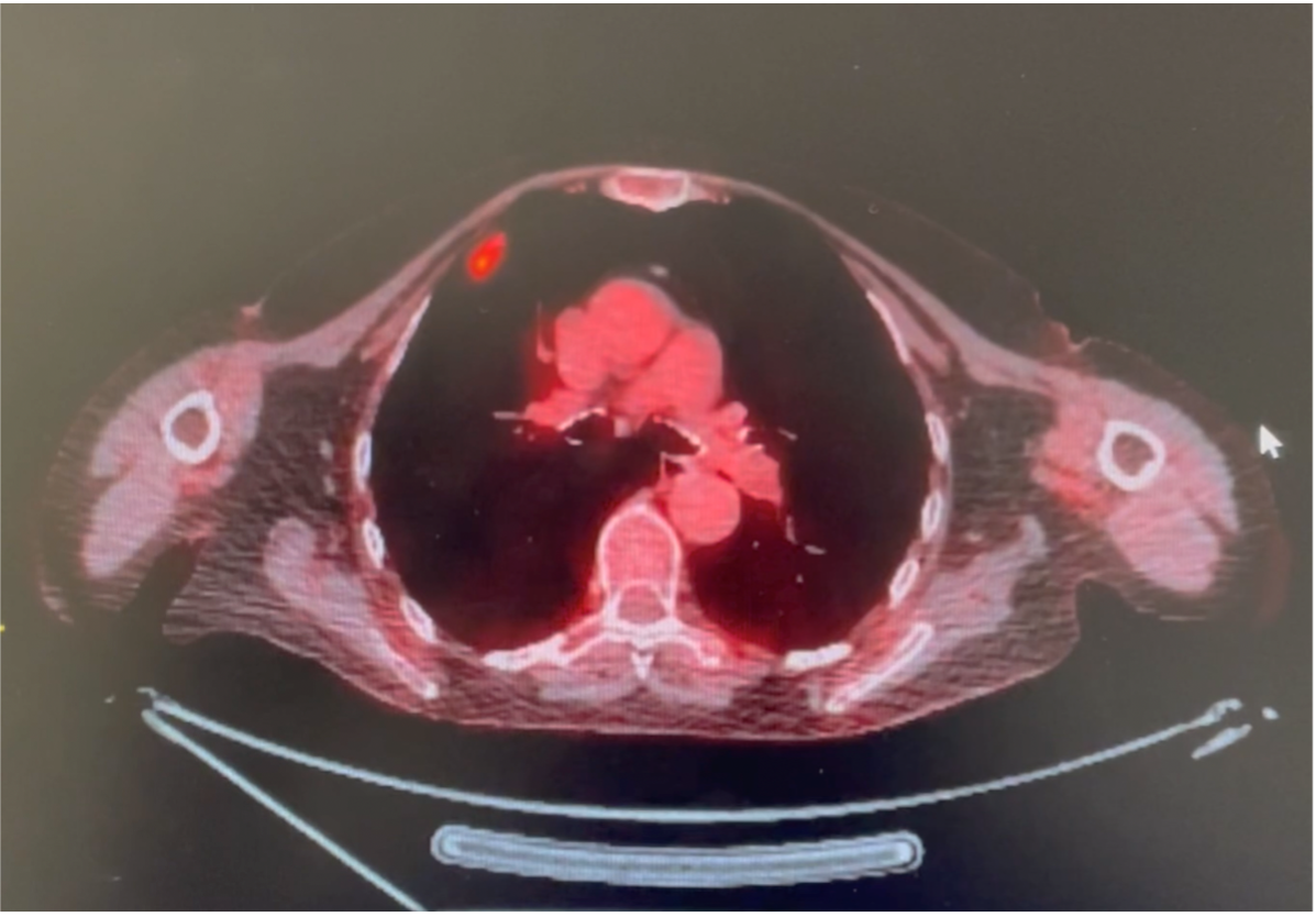 Video atlas of pulmonary segmentectomy: robotic-assisted right S3 ...