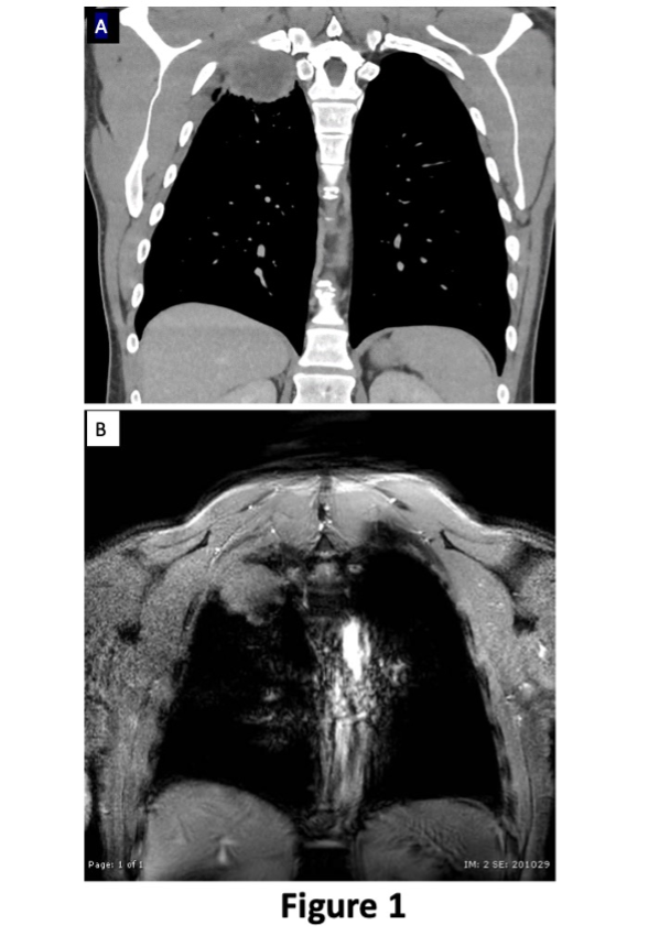 Chest Wall Resection With Robotic Assisted Thoracoscopic Surgery For A Pancoast Tumour A Case